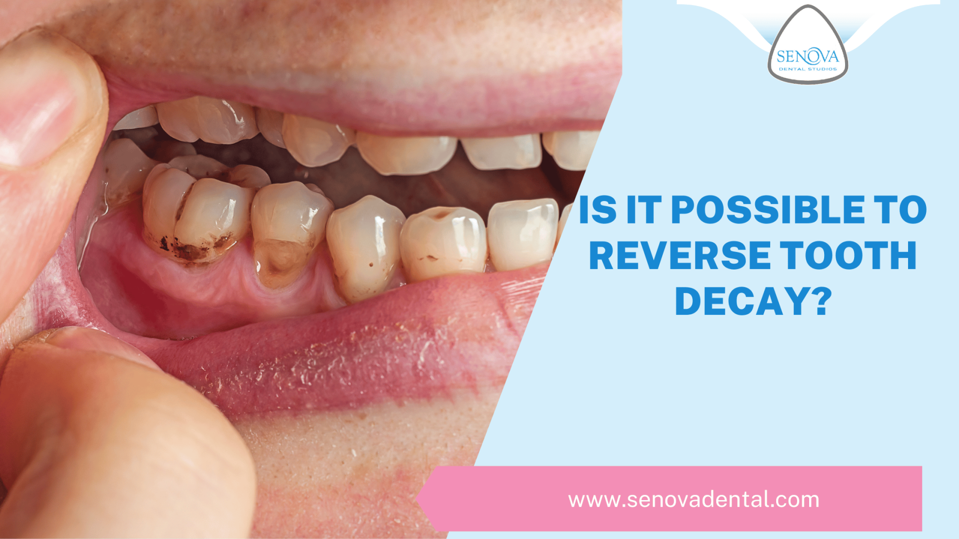 Is It Possible To Reverse Tooth Decay? – Senova Blog