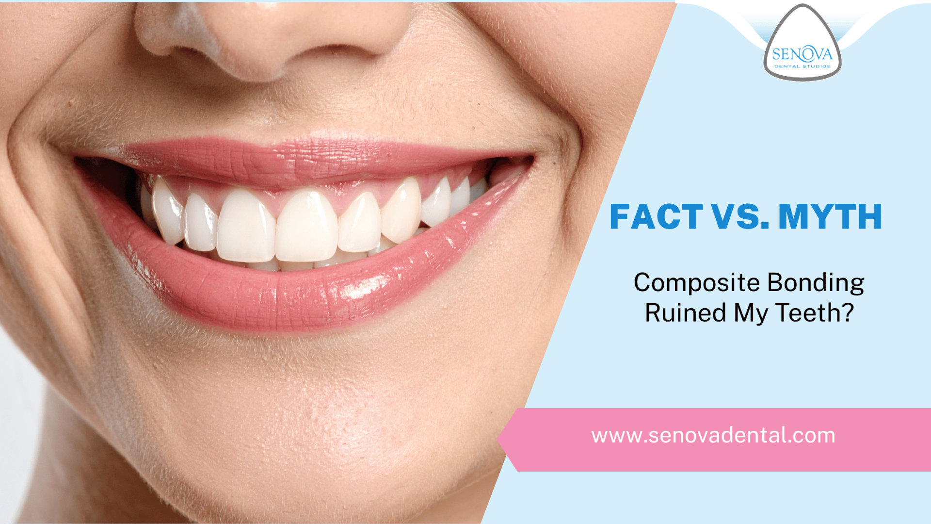 Fact Vs. Myth: Composite Bonding Ruined My Teeth? – Senova Blog